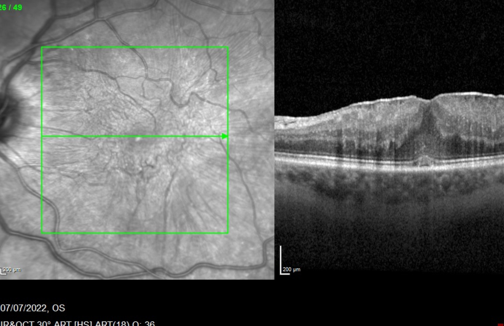 Epiretinal Membrane (ERM): Causes, Symptoms, and Treatment - Miss Anna ...